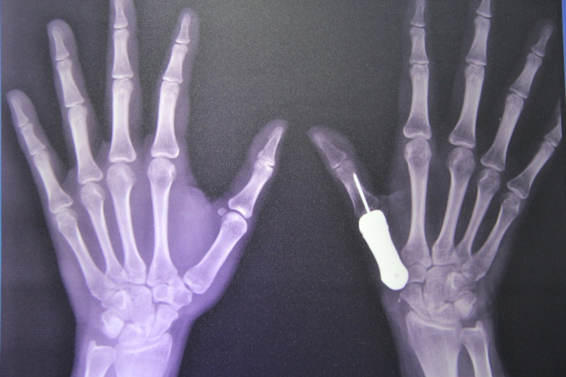 Thai team transplants world’s first working titanium thumb