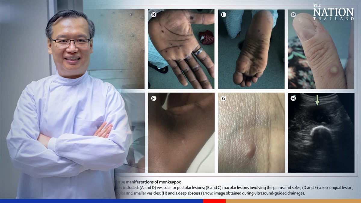 Virologist offers advice on keeping monkeypox at bay