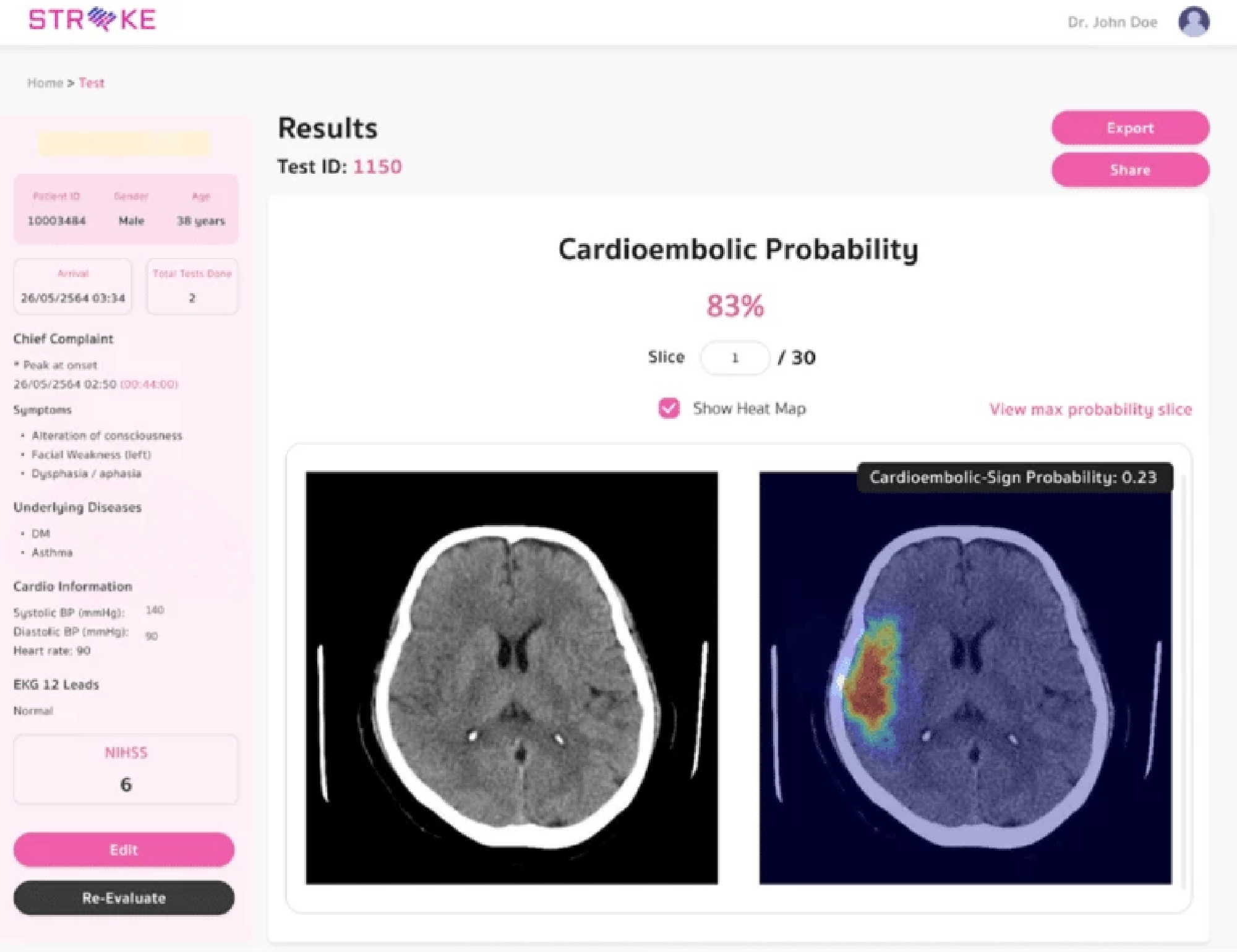 Chula’s AICute Innovation – An Assessment Tool for Ischemic Stroke Risk