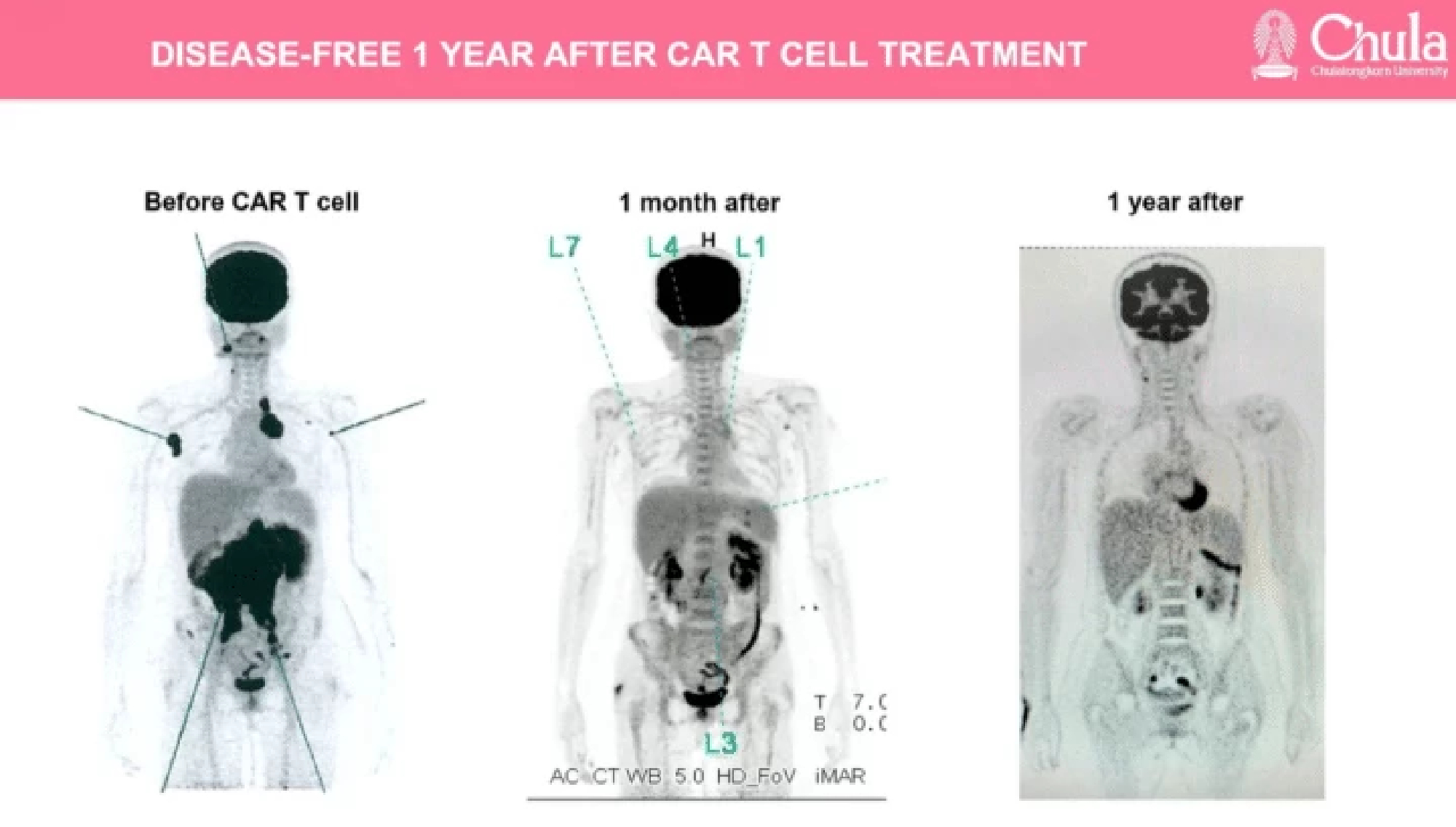 CAR T-Cell Therapy” Innovation: New Hope for Thai Lymphoma Cancer Patients
